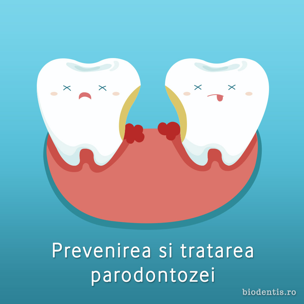 Parodontoza - semne si cum putem s-o tinem departe » Clinica BioDentis